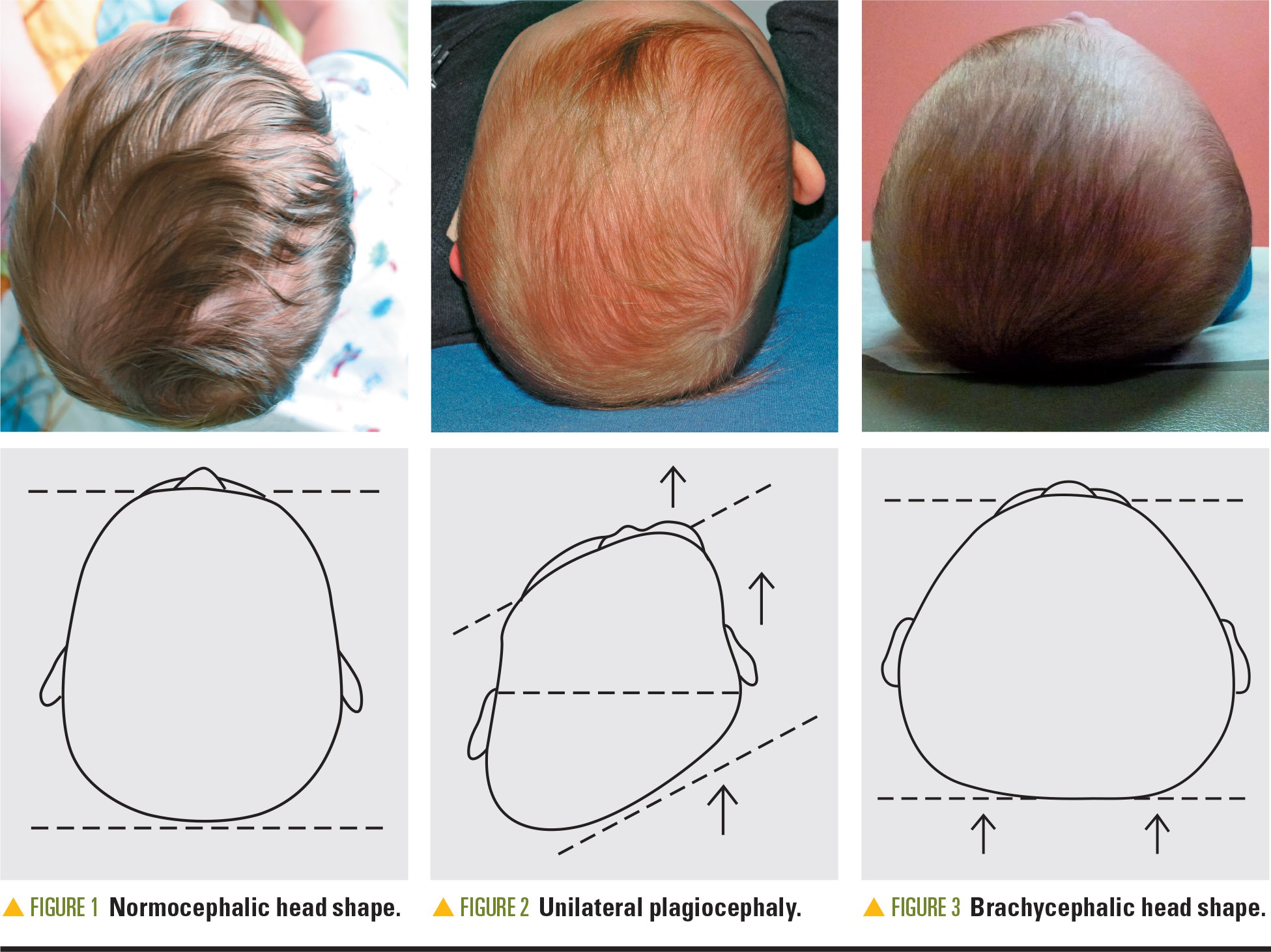 Plagiocephaly and torticollis complications - Physio4you